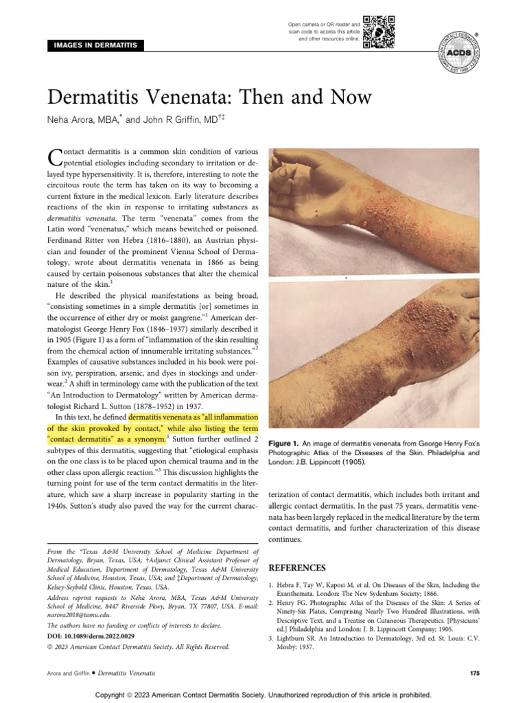 History of Dermatitis Venenata | PDF | Dermatitis | Medicine
