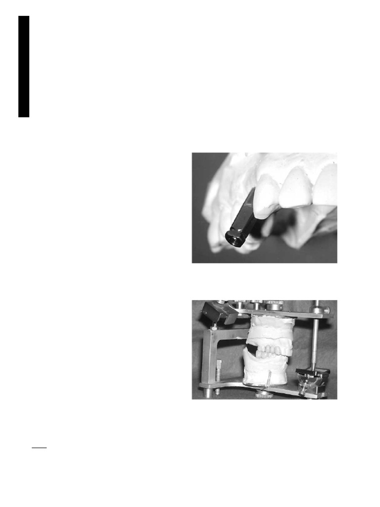 Surgical Guide for Implant Placement | PDF | Dental Implant | Dentistry