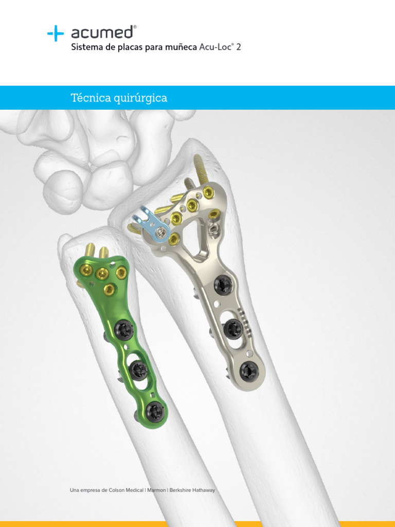 Acumed Surgical Technique ES Acu Loc 2 ESHNW00 06 D | PDF | Tornillo