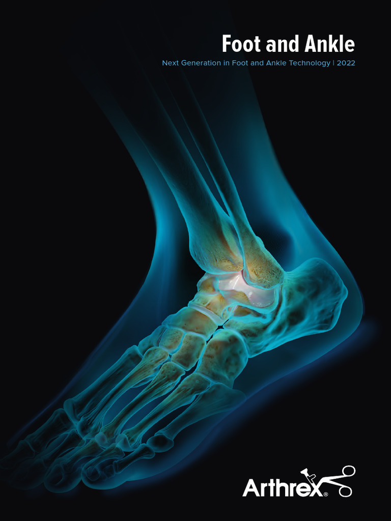Arthrex Lateral Column Lengthening Guide | PDF | Ankle | Surgery