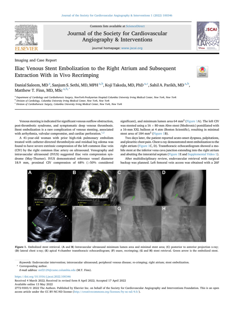 Iliac Venous Stent Embolization To The Right Atriu | PDF | Vein ...