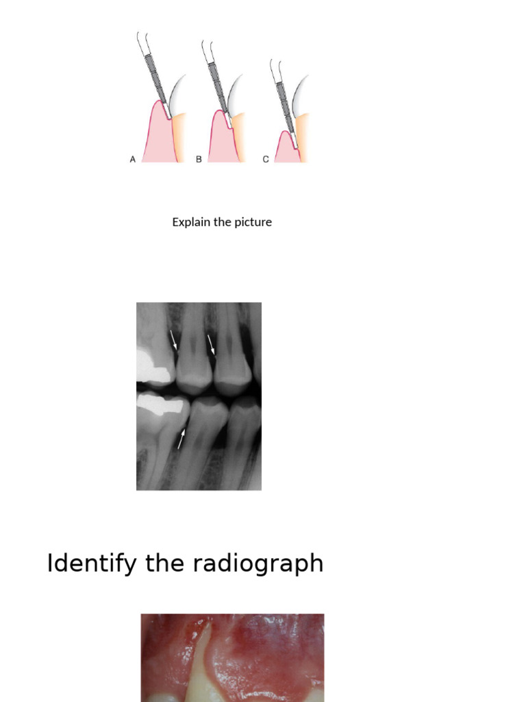 Presentation Perio exam | PDF