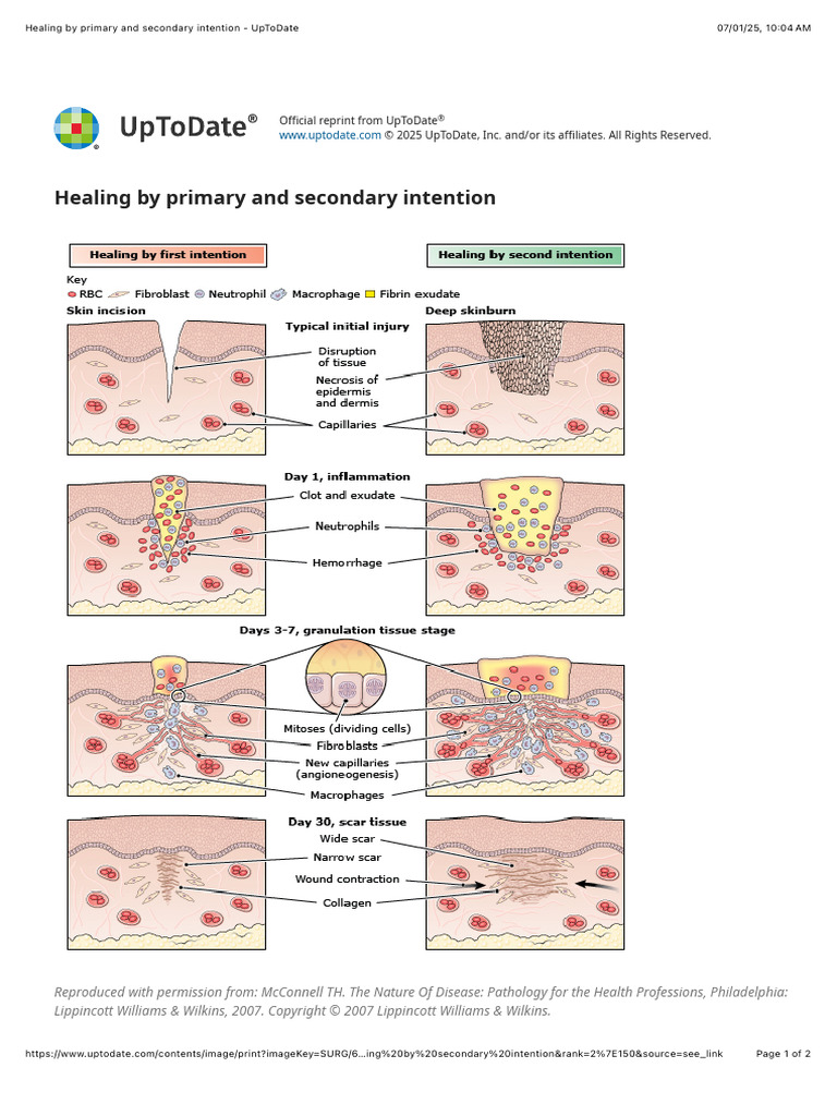 Healing by Primary and Secondary Intention - UpToDate | PDF