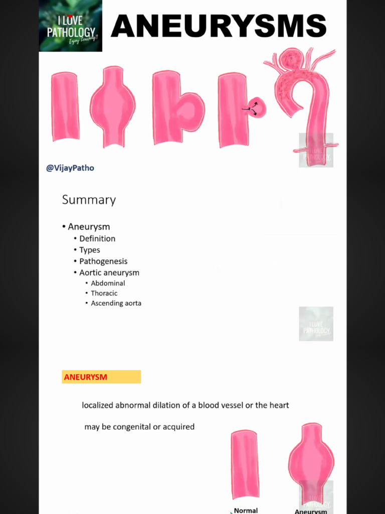 Aneurysm and Aortic Dissection (Refer Ramdas Too) | PDF