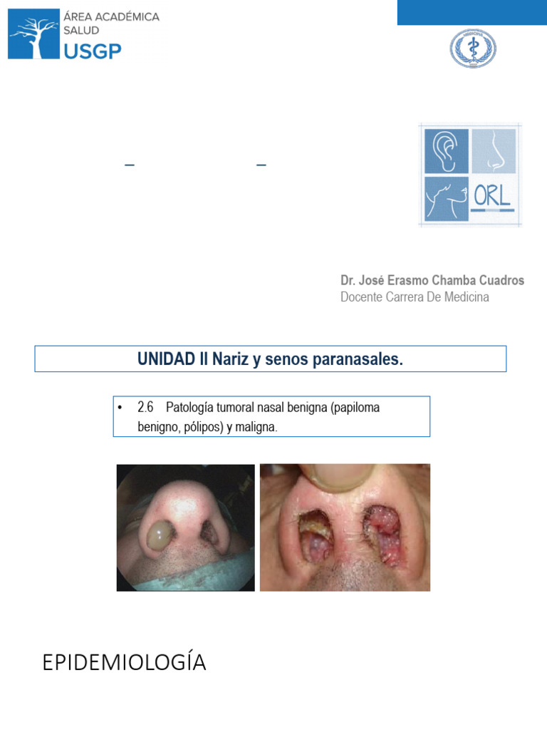Tumores Nasales: Diagnóstico y Tratamiento | PDF | Cáncer | Otorrinolaringología