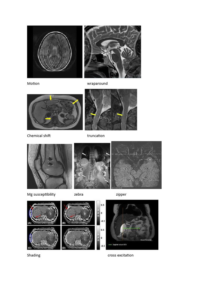 mri artifact | PDF