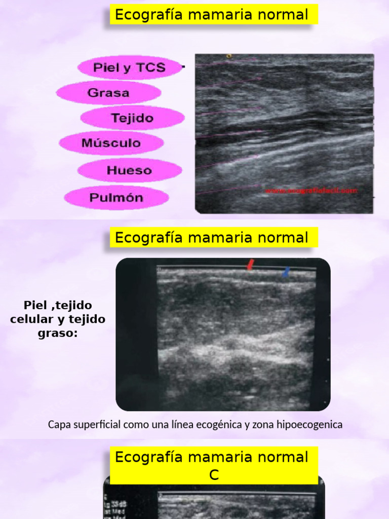 Ecografía Mamaria Normal y Patologías | PDF