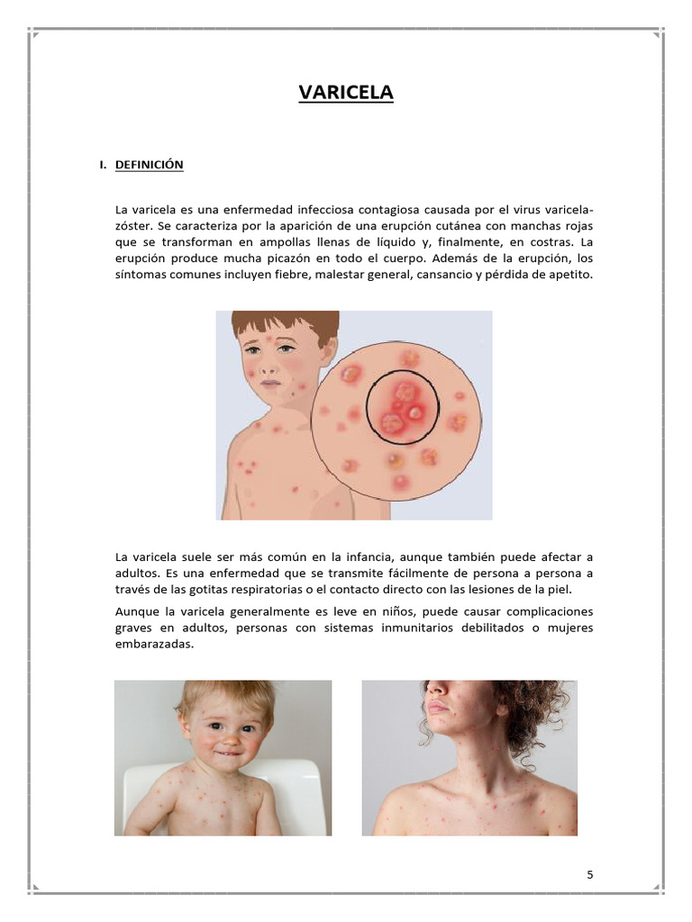 Varicela | PDF | Sistema inmune | Salud pública