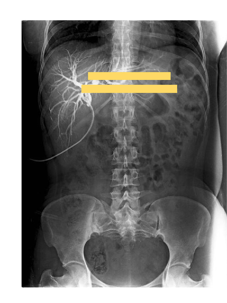 Colangiografia Intraoperatoria y CPRE final 1 | PDF | Bilis | Medicina ...