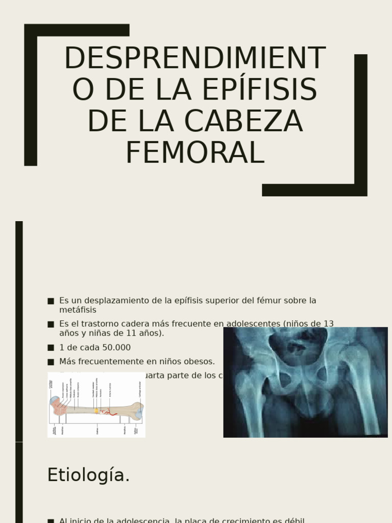 Desprendimiento de La Epífisis de La Cabeza Femoral | PDF | Rodilla ...