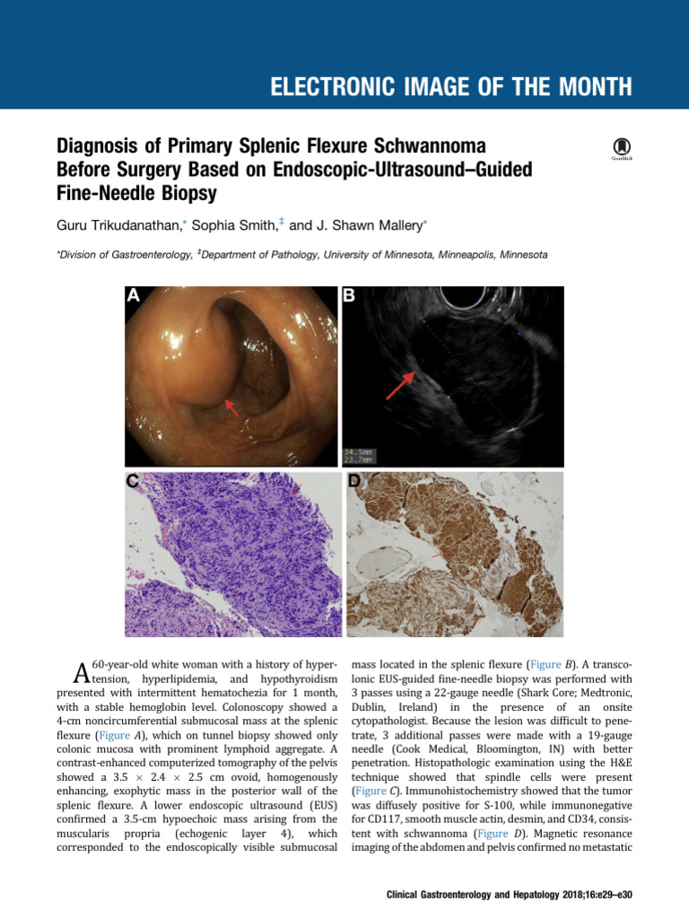Diagnosis of Primary Splenic Flexure Schwannoma Be | PDF | Neoplasms ...
