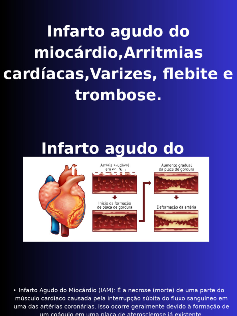 Infarto Agudo do Miocárdio e Arritmias | PDF | Infarto do Miocárdio ...
