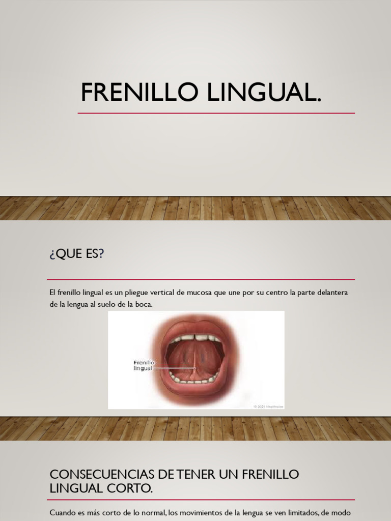 Frenillo Lingual Corto: Consecuencias y Tratamiento | PDF