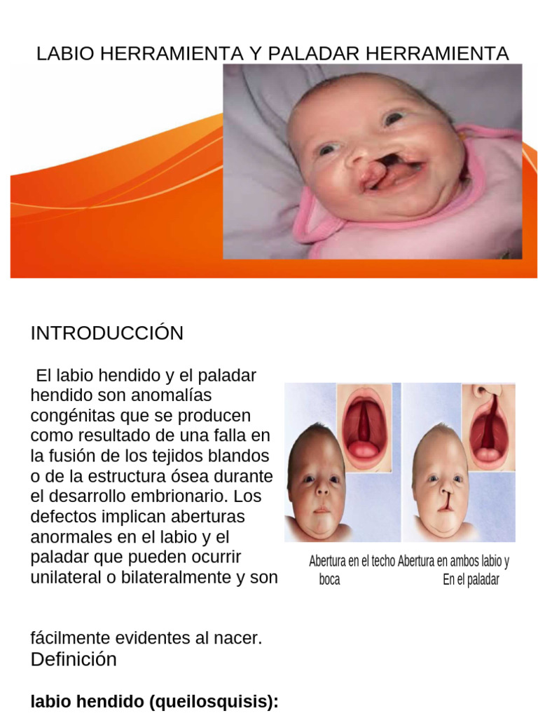 Labio Leporino y Paladar Hendido | PDF | El embarazo | Enfermedades y trastornos