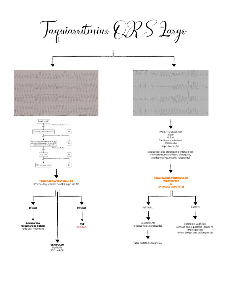 Taquiarritmias de QRS Largo | PDF