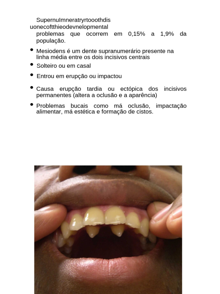 supernumerário Mesiodens | PDF | Dente humano | Anatomia dental