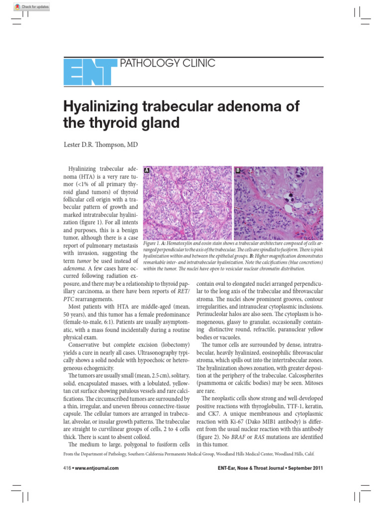 ENTJ-2011-09 - Hyalinizing Trabecular Adenoma of The Thyroid Gland ...
