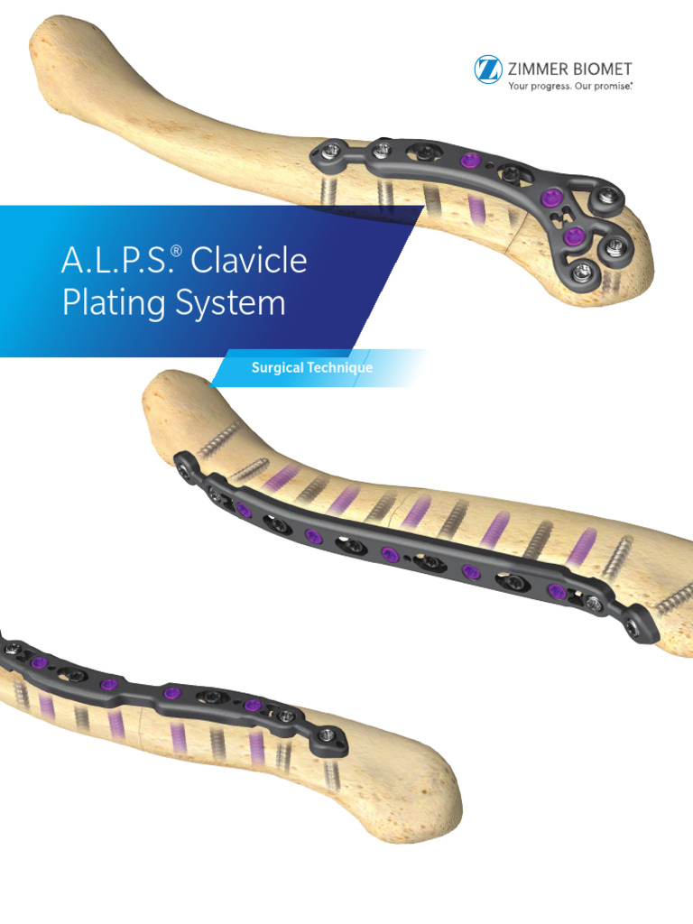 Alps Clavicle Surgical Technique 20201 | PDF | Shoulder | Anatomical ...