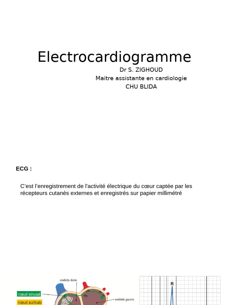 Guide Pratique de l'ECG pour Soignants | PDF | Électrocardiographie ...