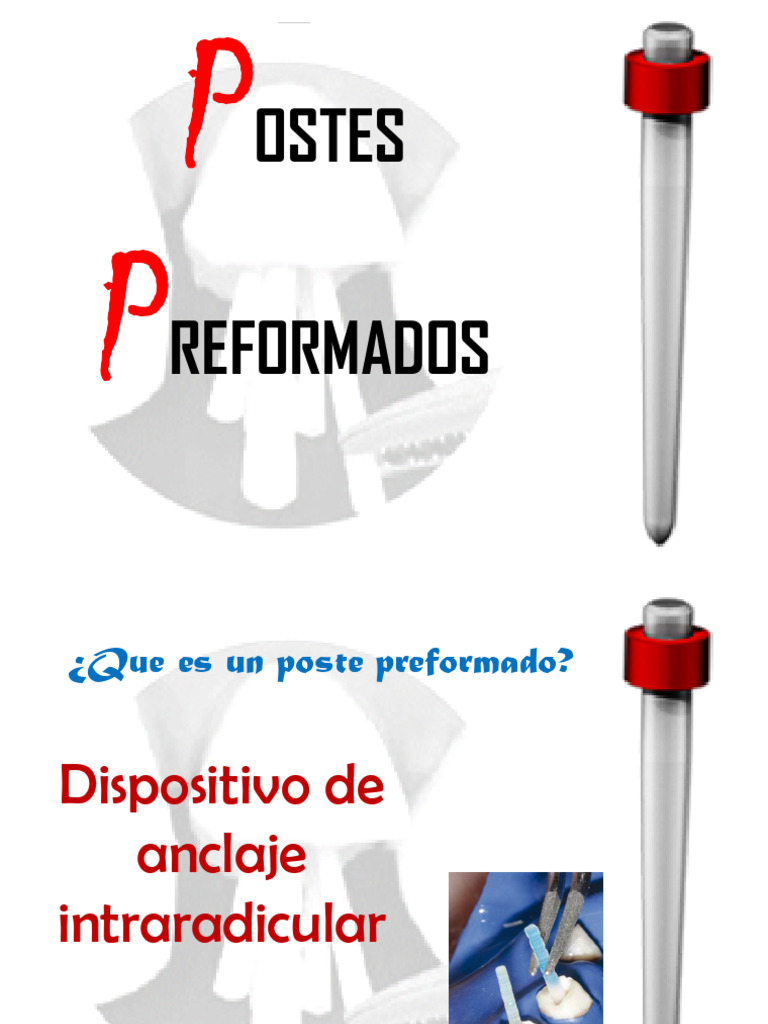 Postes Preformados: Tipos y Funciones | PDF | Diente | Materiales de ...