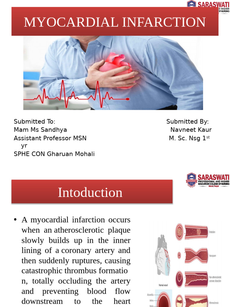 Myocardial Infarction | PDF | Myocardial Infarction | Heart