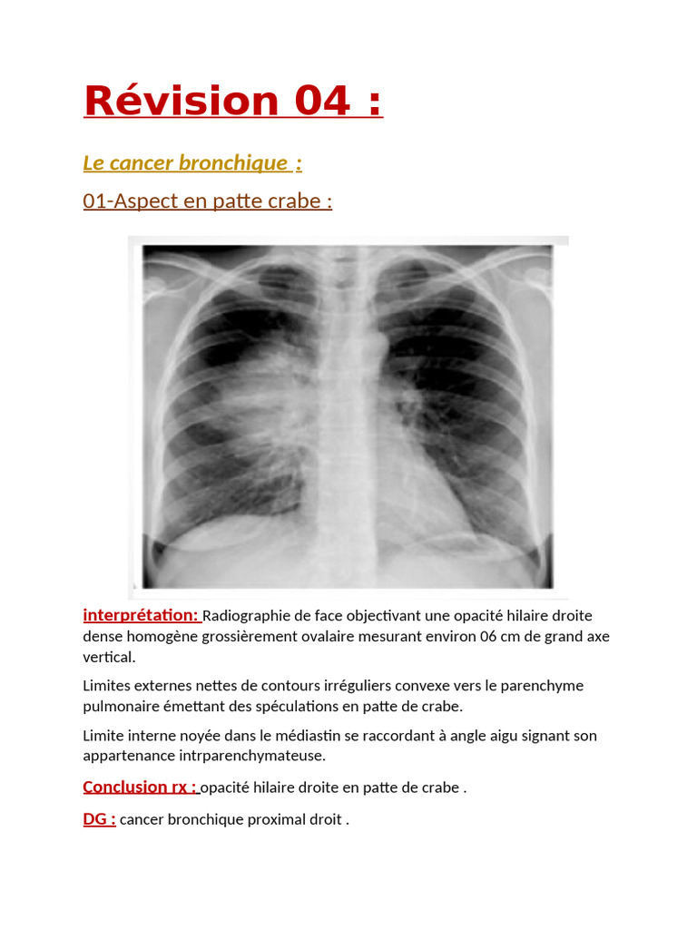 Cancer bronchique : interprétations radiologiques | PDF | Cancer du ...
