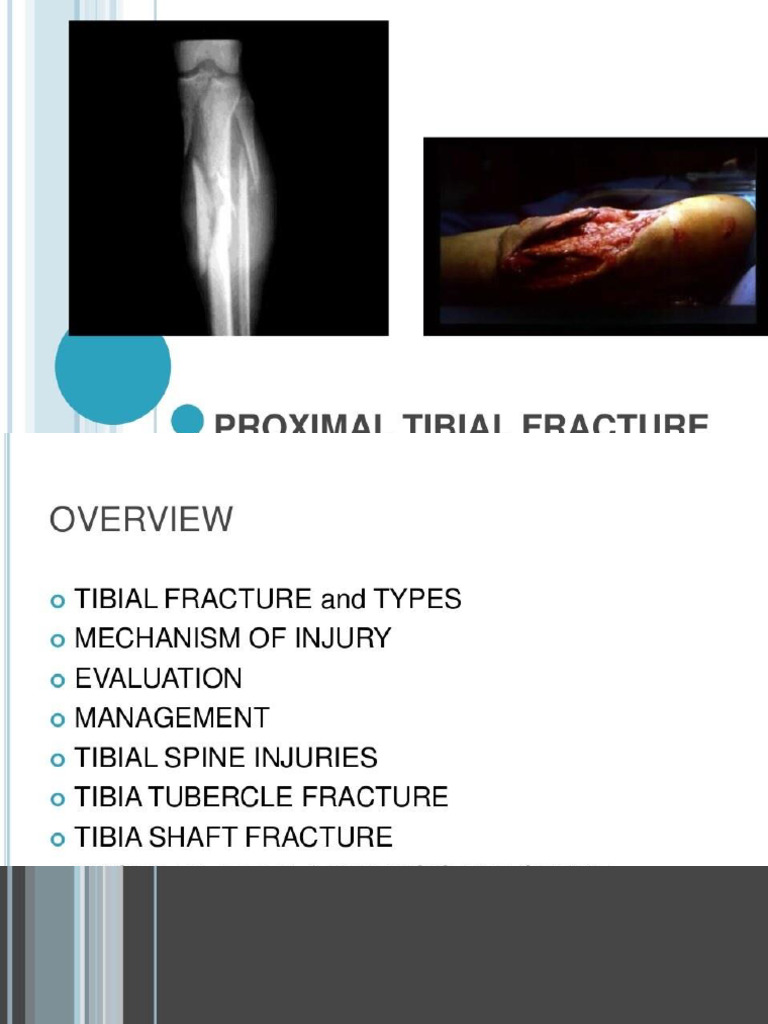 Proximal Tibial Fracture | PDF
