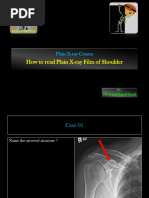 Grashey Method for Shoulder Imaging | PDF | Shoulder | Musculoskeletal ...