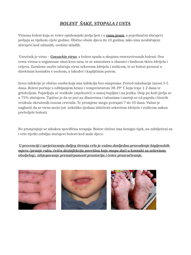 Bolest Šake, Stopala I Usta | PDF