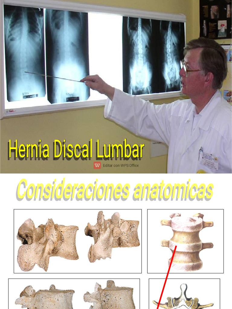Hernia Discal Lumbar | PDF | Anatomía humana | Especialidades Medicas