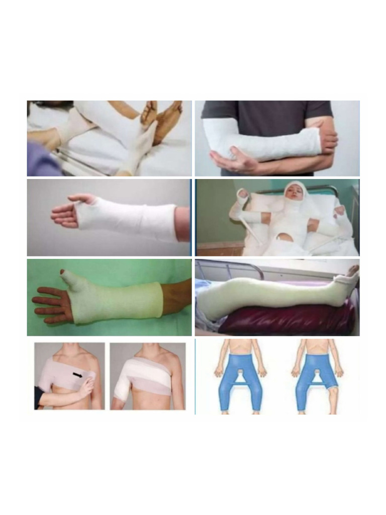 cast and splint and ambulation | PDF
