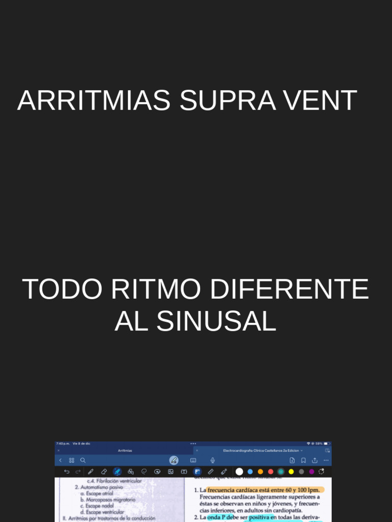 Arritmias Supraventriculares | PDF