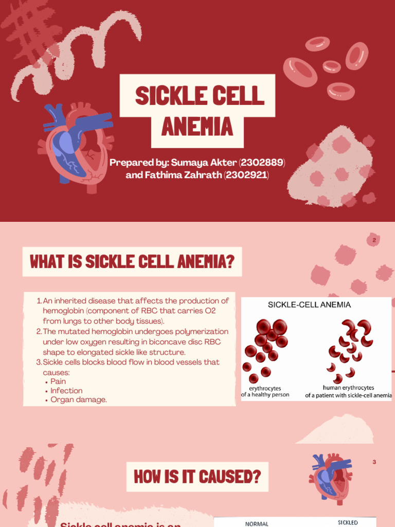 Sickle Cell Anemia disease | PDF | Anemia | Hemoglobin
