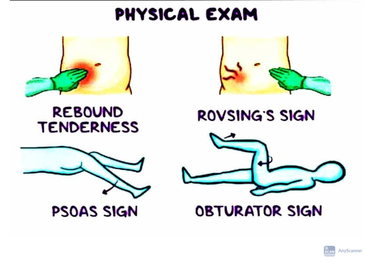 APPENDICITIS SIGN TRICK | PDF