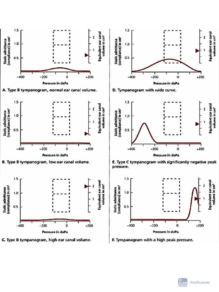 TYMPANOGRAM TYPES | PDF
