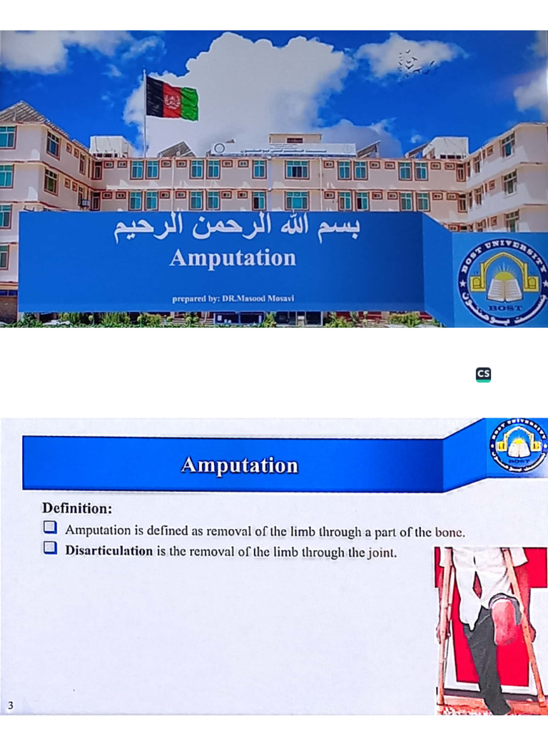 Amputation | PDF