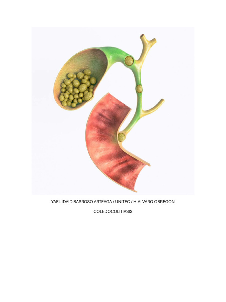 COLEDOCOLITIASIS | PDF | Bilis | Gastroenterología