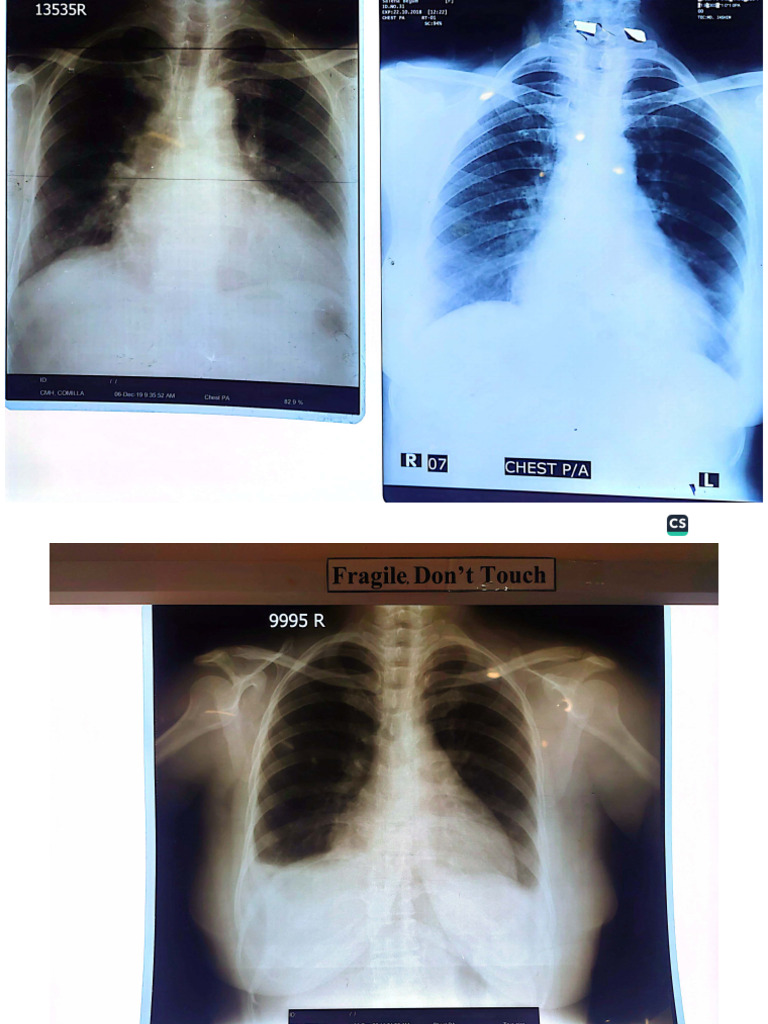Cardiomegaly | PDF