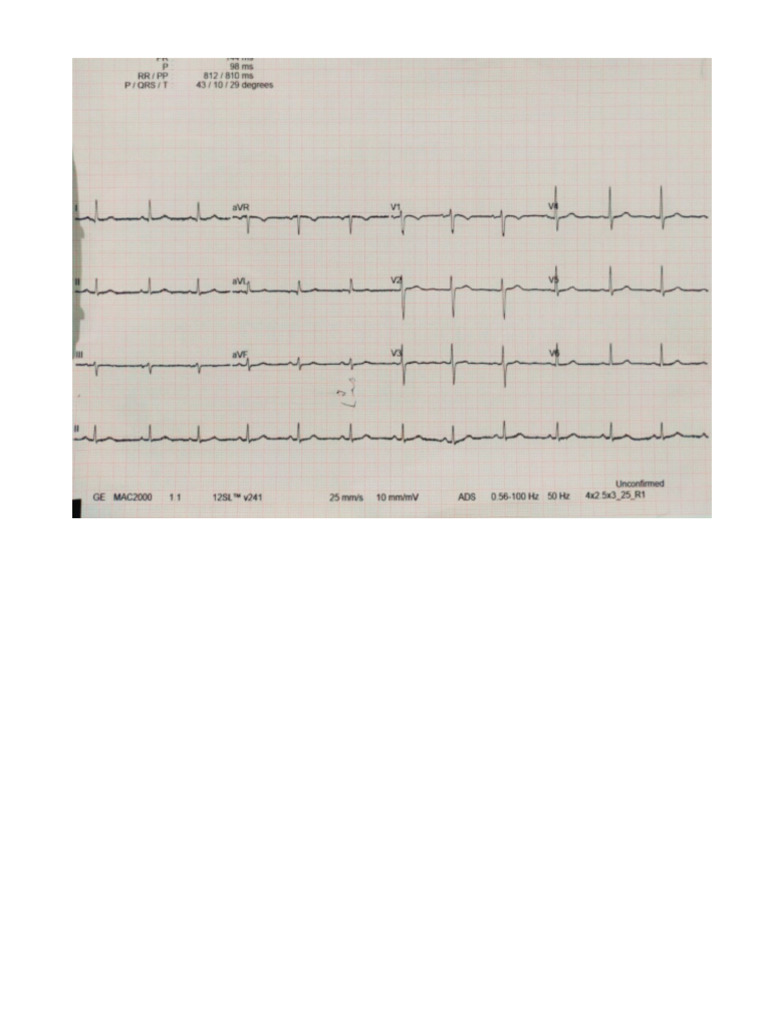 EKG | PDF
