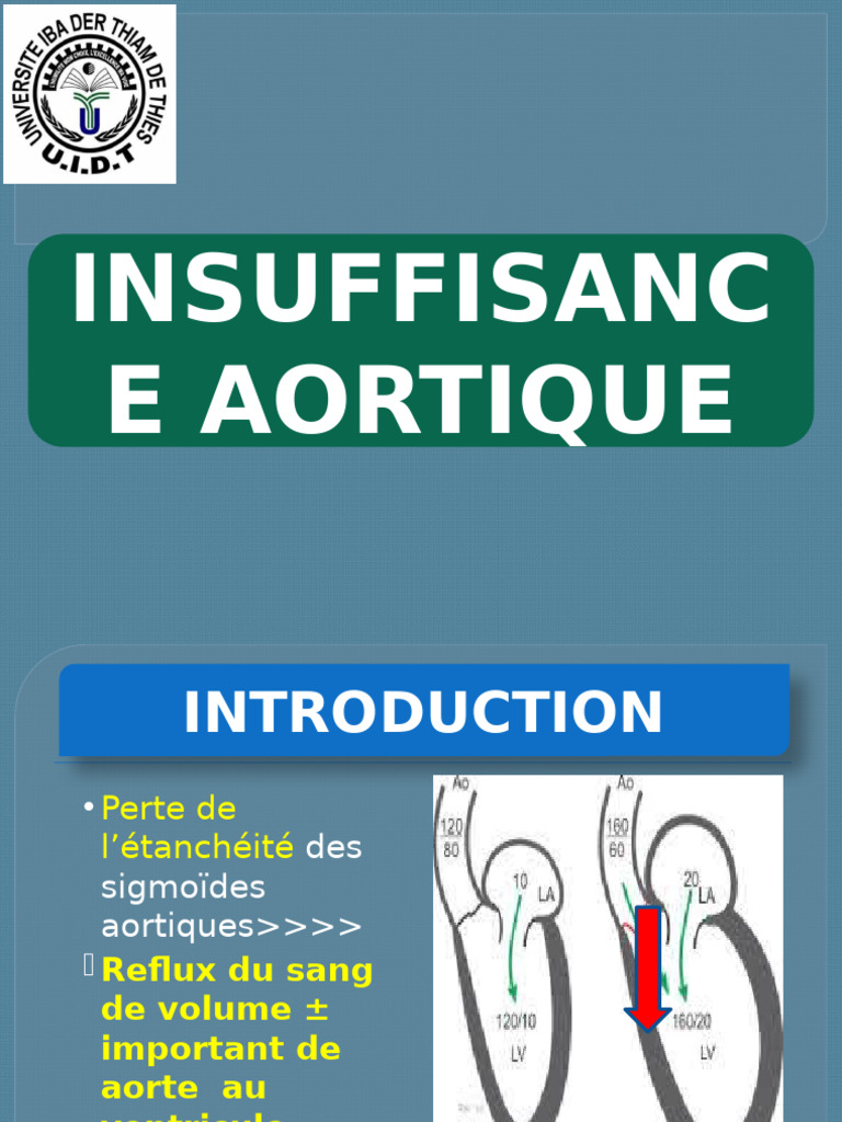 Insuffisance Aortique Short | PDF | Maladies et troubles | Système circulatoire
