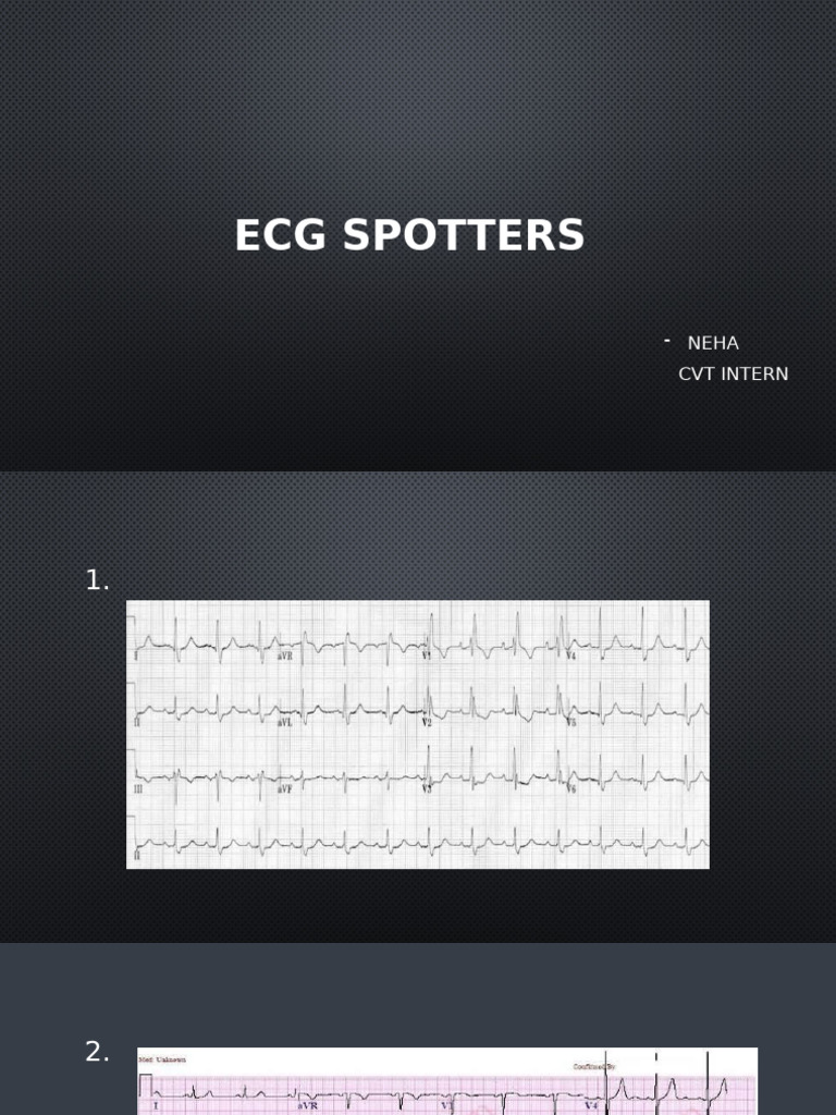 Ecg Spot | PDF