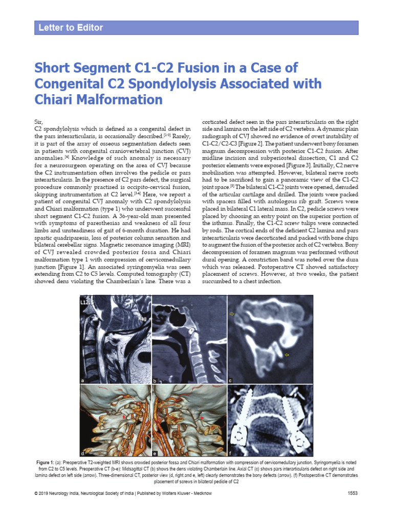 Short Segment c1 c2 Fusion in A Case of Congenital.40 | PDF | Vertebra ...