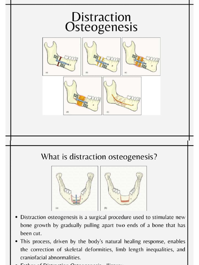 Distraction Osteogenesis | PDF