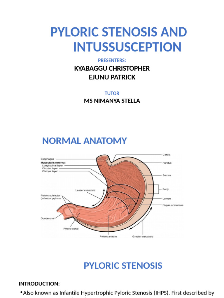 Pyloric Stenosis and Iss | PDF | Gastroenterology | Diseases And Disorders