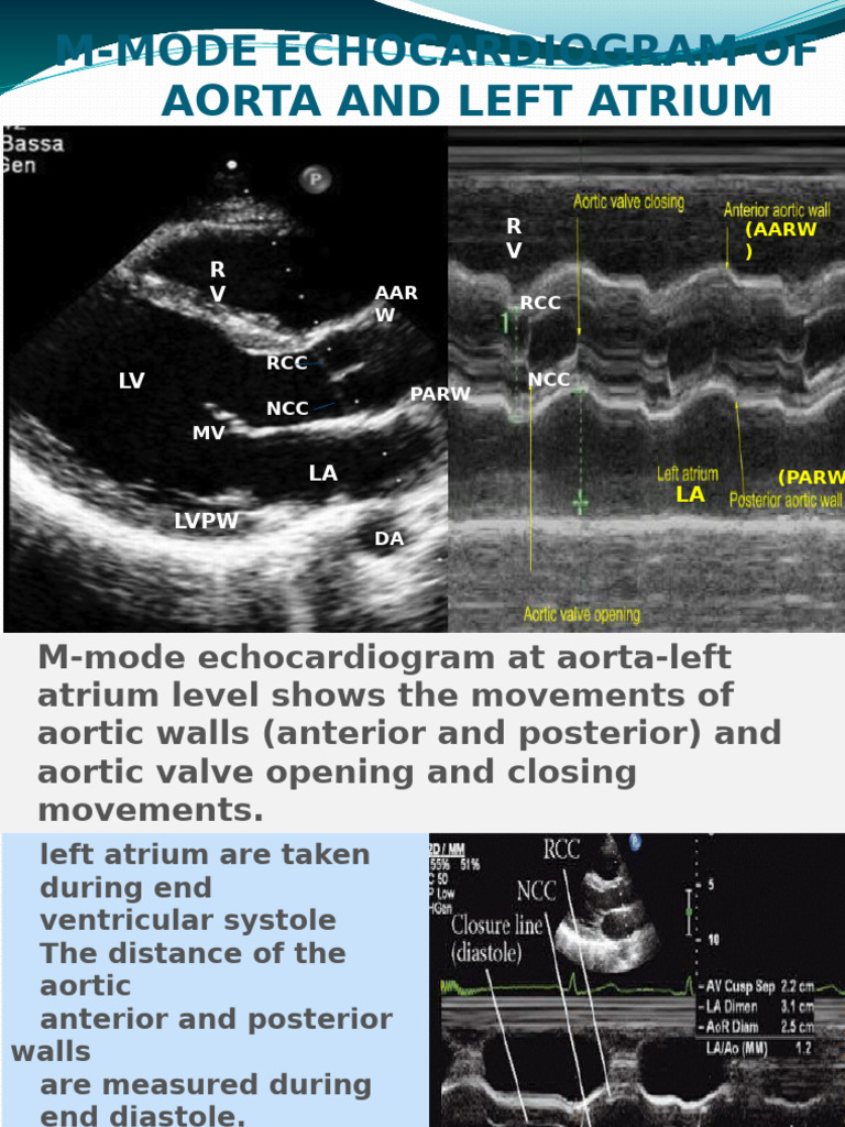 M-Mode Echocardiogram Aorta & LA Analysis | PDF | Heart Valve | Diastole