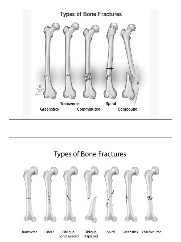 Fracture Notes | PDF