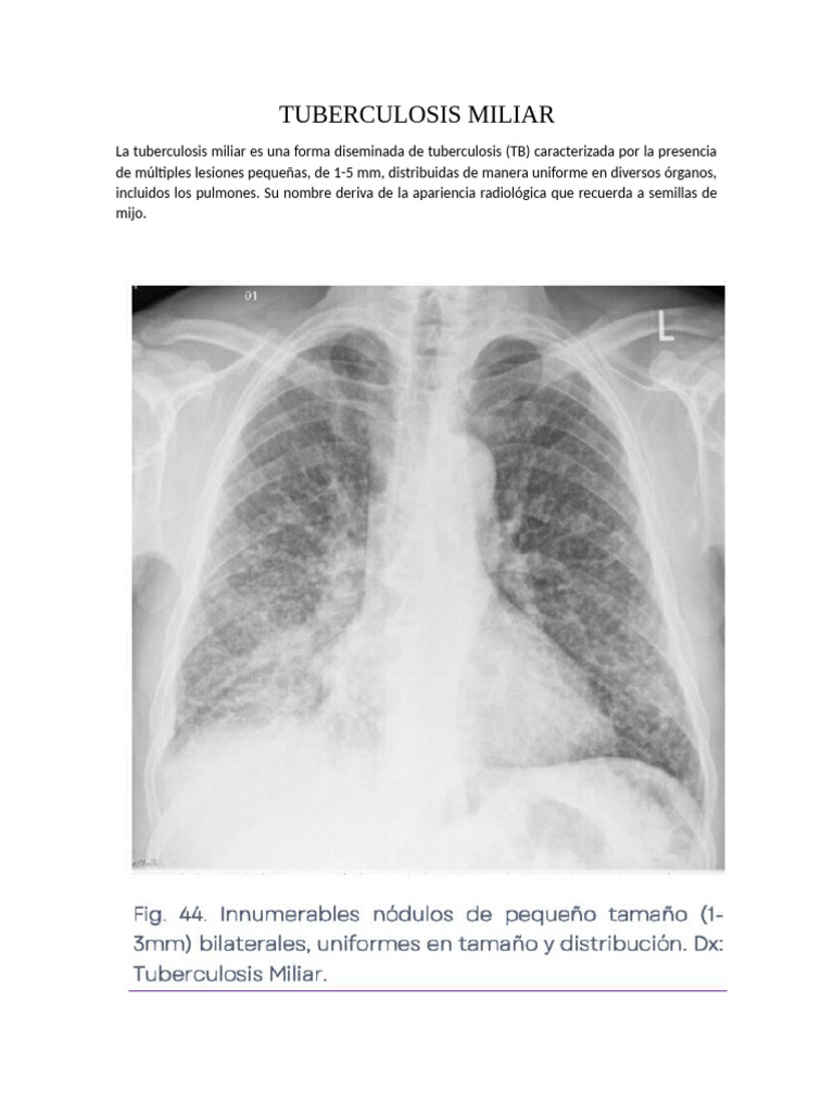 Tuberculosis Miliar: Diagnóstico y Características | PDF