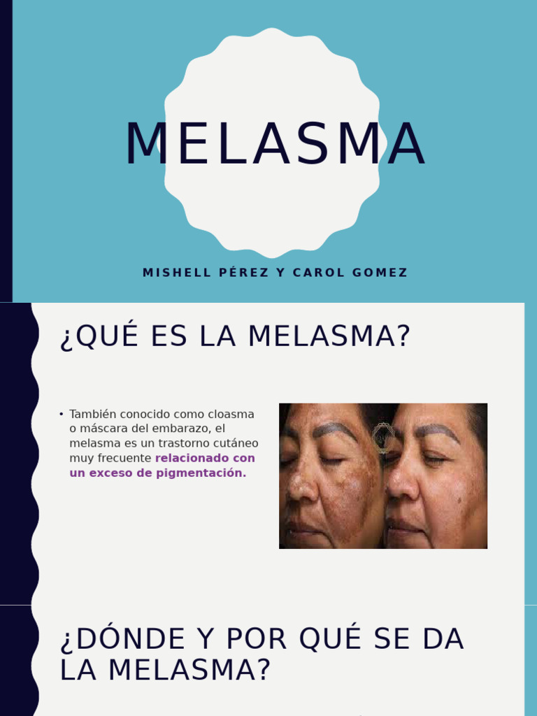 MELASMA | PDF