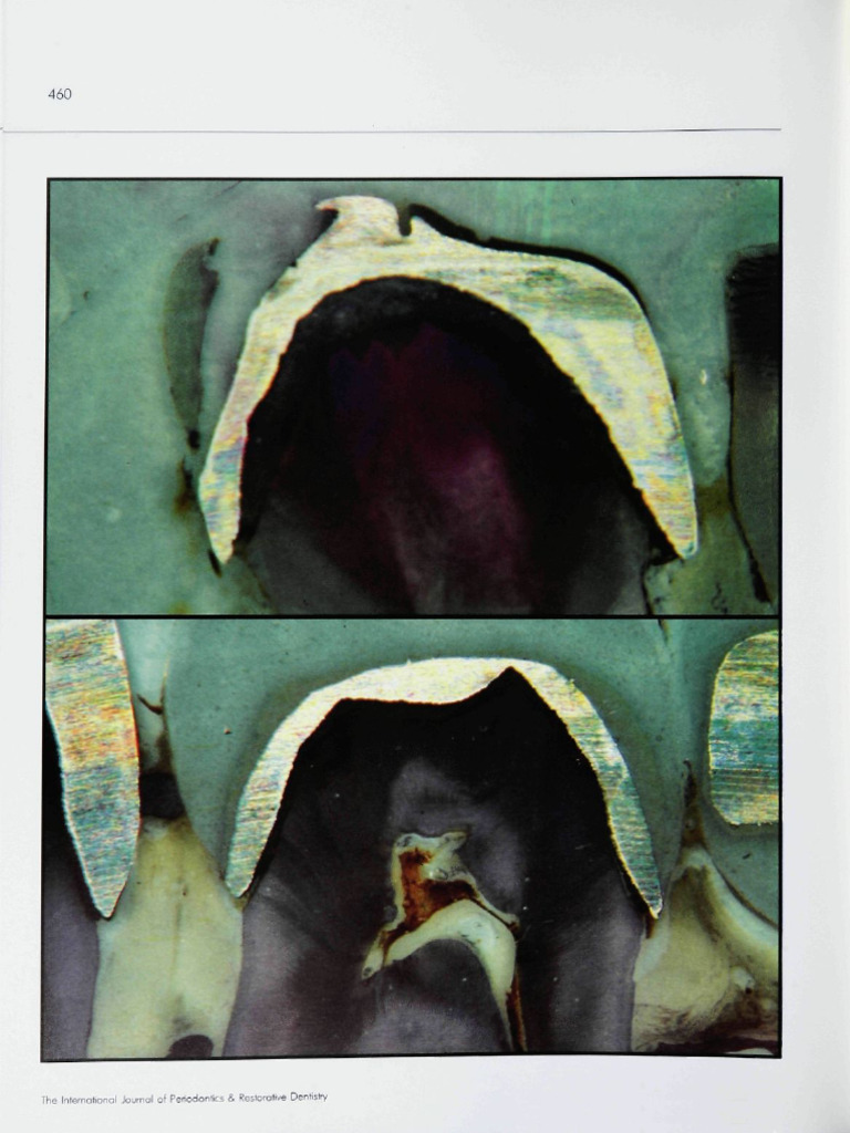 Dentists: Mastering Margin Placement | PDF | Periodontology | Dentistry ...