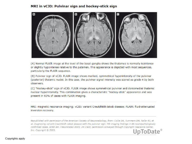 MRI_in_vCJD__Pulvinar_sign_and_hockey_stick_sign | PDF